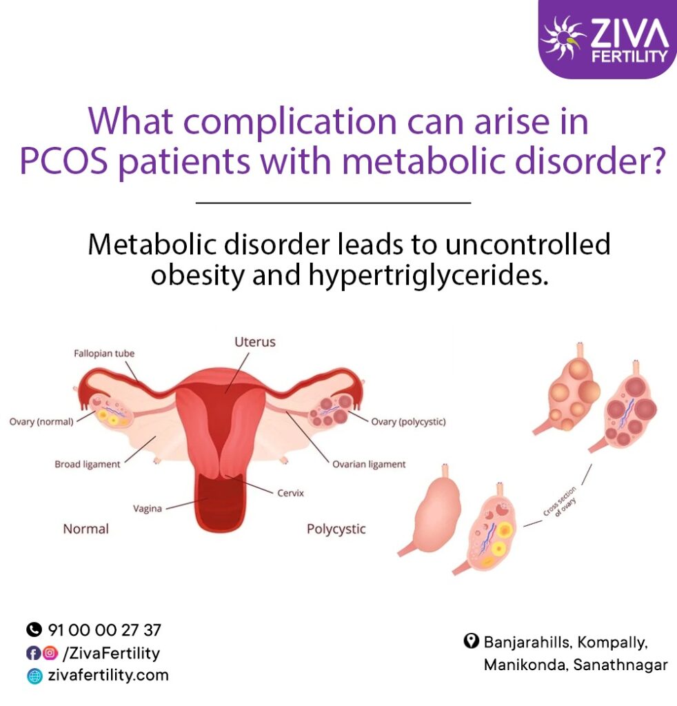 Complications of Metabolic Disorder in PCOS Patients – Ziva Fertility ...